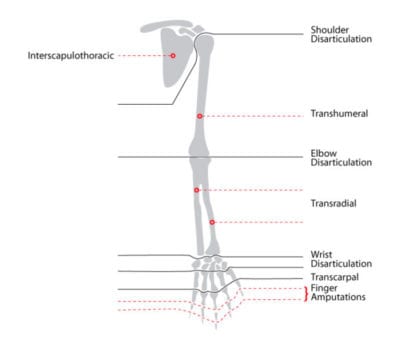 Upper Extremity Prosthetic Devices | WestCoast Brace and Limb