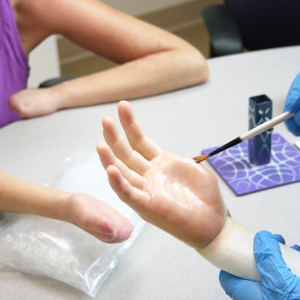 Upper Extremity Prosthetic Devices | WestCoast Brace and Limb