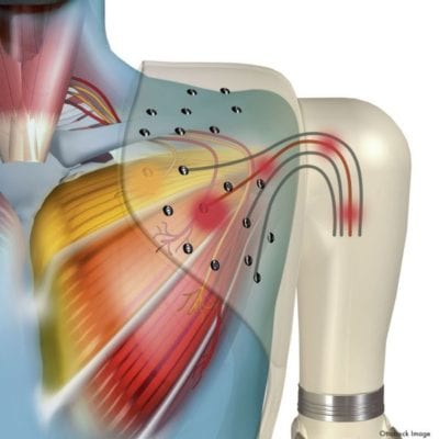 Targeted Muscle Reinnervation | WCBL gives TMR amputees expert care