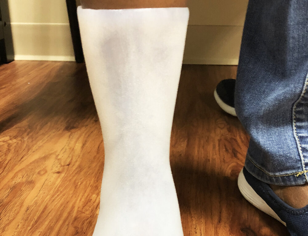 Drop Foot made simple with the TurboMed XTERN AFO | News