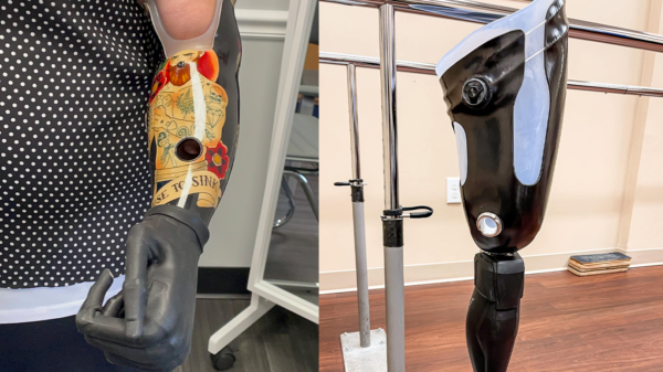 Orthotic and Prosthetic Patient Resource Blog | Westcoast Brace and Limb
