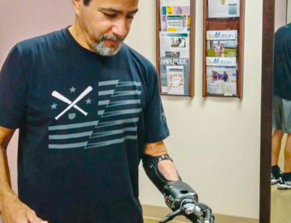 High-Fidelity Interface Prosthetic Leg Socket with HiFi technology