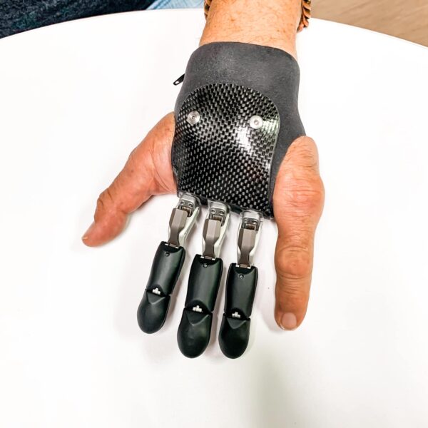 Partial hand and finger prosthetics | Westcoast Brace and Limb ...