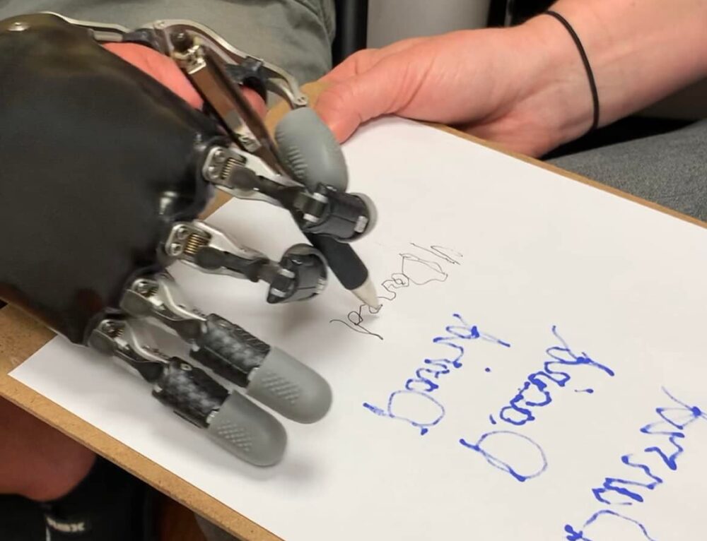 HiFi Interface Technology - Prosthetic Socket | Westcoast Brace & Limb